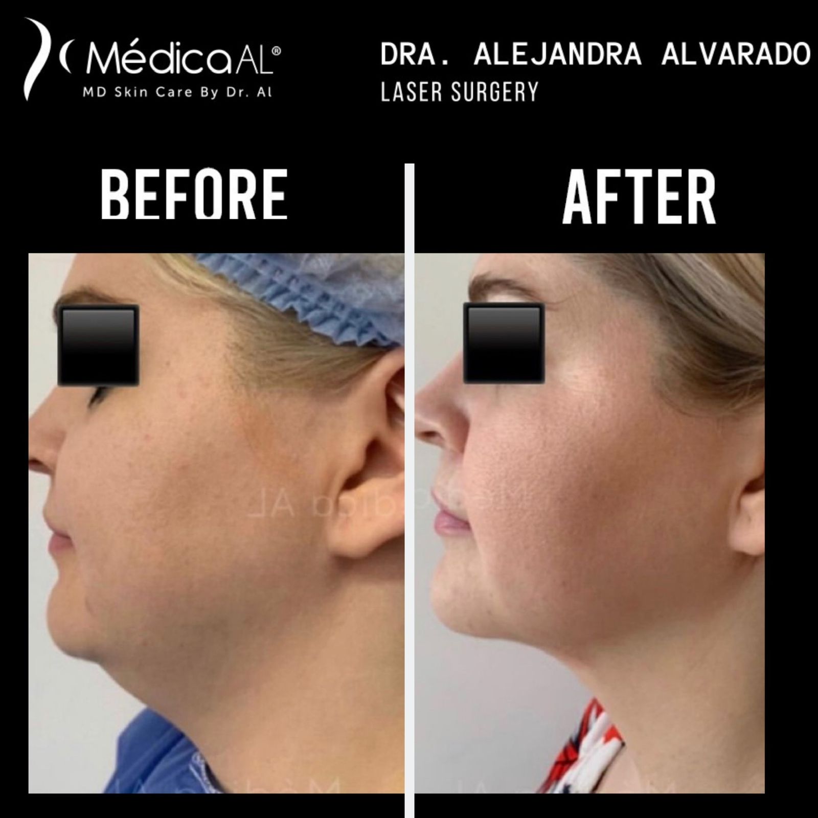 PERFILAMIENTO FACIAL LÁSER – Médica AL