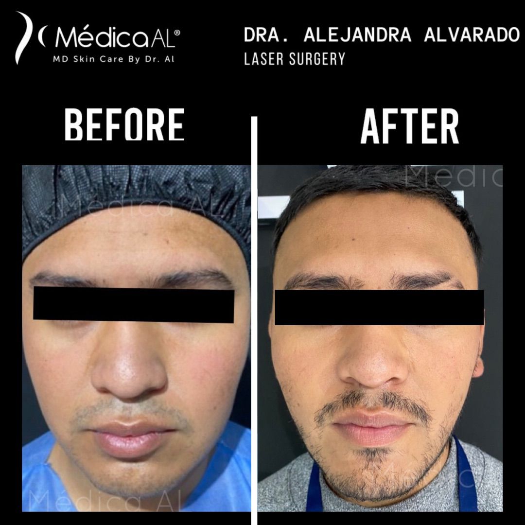 PERFILAMIENTO FACIAL LÁSER - Médica AL ⭐