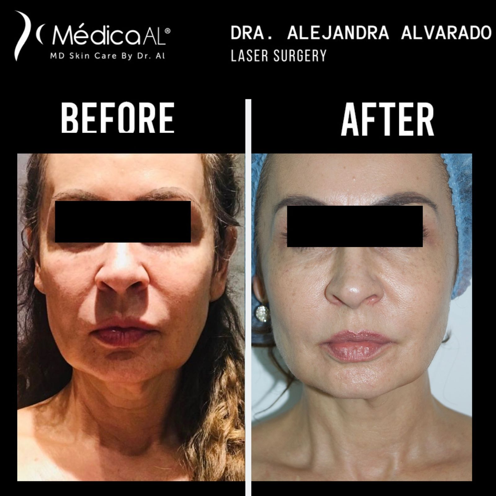 PERFILAMIENTO FACIAL LÁSER – Médica AL